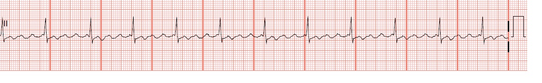Basic ECG Rhythms