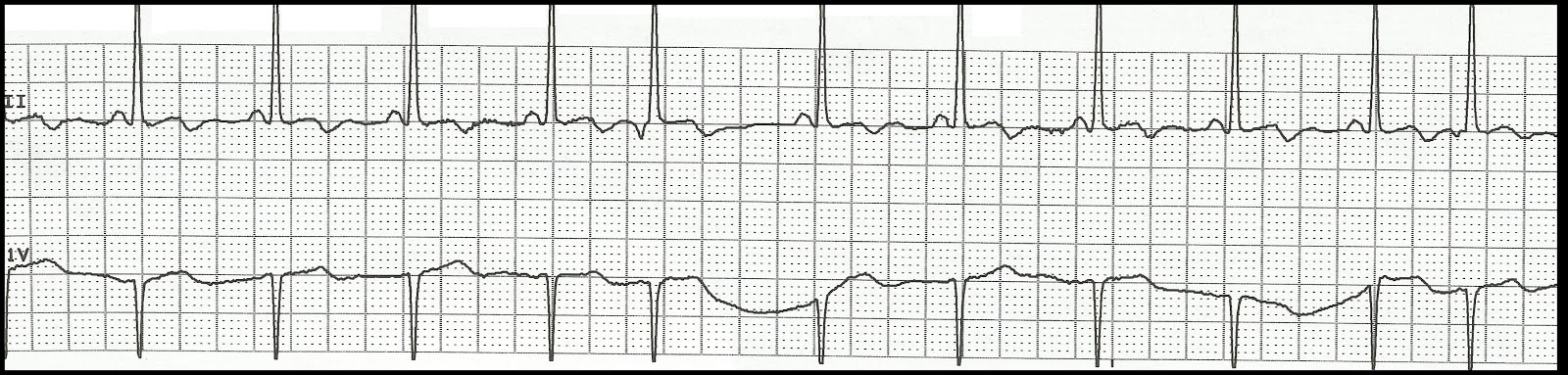 Float Nurse: EKG Rhythm Strip Quiz 104