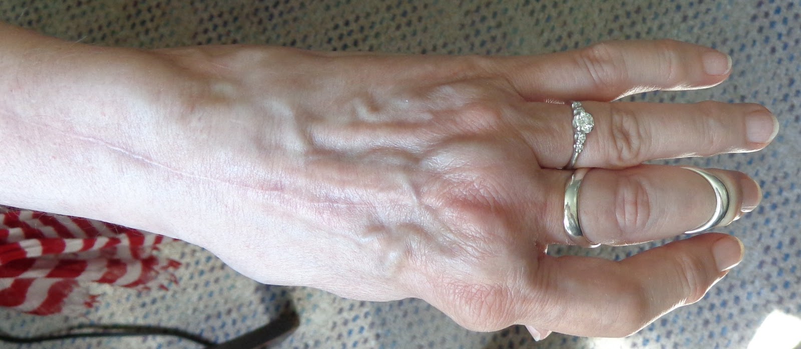 Here's Your Gold Watch - Rheutired: Update on wrist fusion surgery