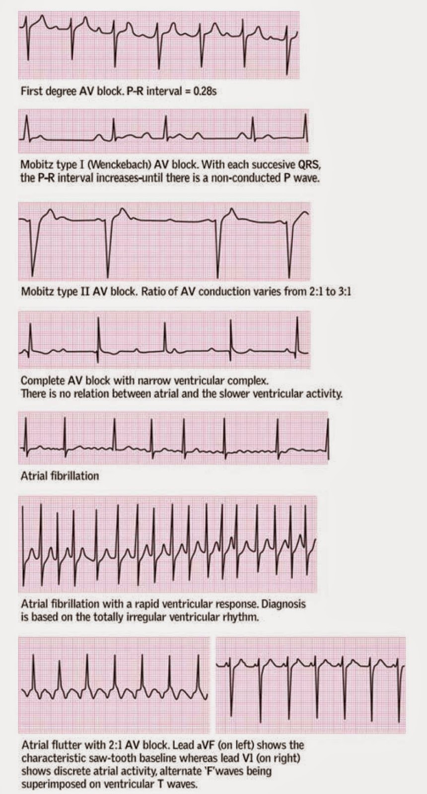 IMAM Moscow Student Chapter: Pathological ECG findings | ARRHYTHMIA