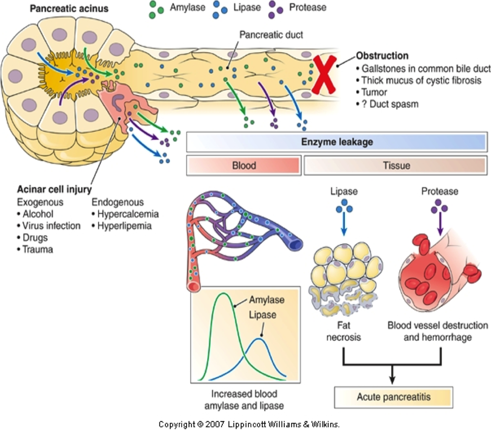 Residentes Medicina Interna HNERM: Pancreatitis Aguda