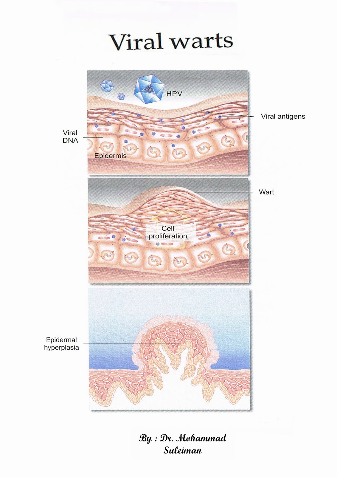 Homöopathie für Heilung: Warts and Its Homoeopathic Approach
