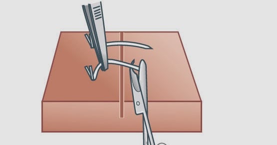 Removing Sutures and Staples ~ Nursing