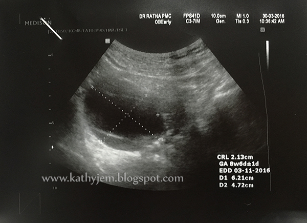 kathyjem: Ada Ovarian Cyst Dalam Perut