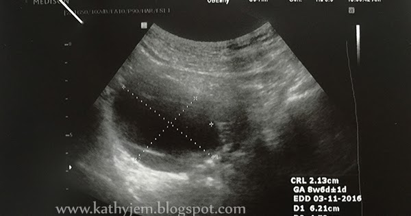 kathyjem: Ada Ovarian Cyst Dalam Perut