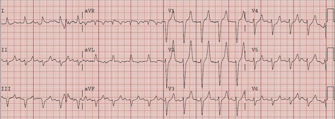 Dr. Smith's ECG Blog: HyperKalemia with Cardiac Arrest. Peaked T waves ...