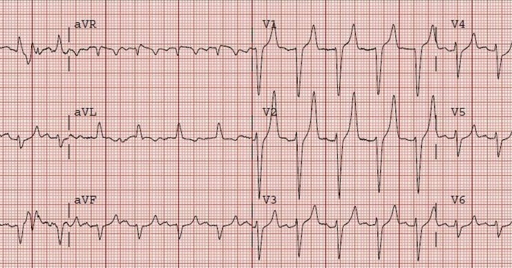 Dr. Smith's ECG Blog: HyperKalemia with Cardiac Arrest. Peaked T waves ...