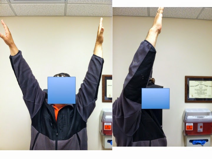 Shoulder and Elbow Surgery: Is there a role for mini open rotator cuff ...