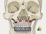 Braces, Jaws, and Joints. : Le Fort 1 Surgery