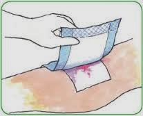 Materiais de penso com acção terapêutica - Enfermagem em Ortopedia