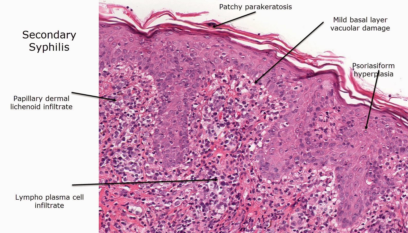 Dermatopathology Made Simple - Inflammatory: Psoriasiform Reaction Pattern