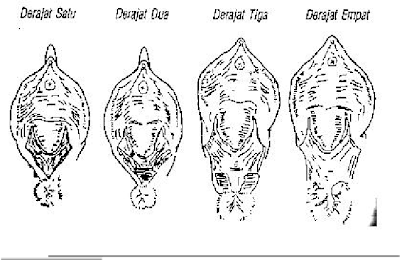 HECTING PERINEUM: HECTING PERENIUM
