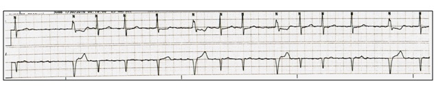 ECG Rhythms: Aberrancy