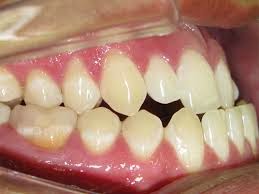 Consultório Odontológico: Classificaçao de Angle