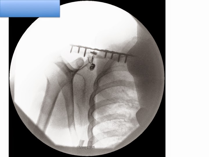 Shoulder and Elbow Surgery: Clavicle fractures. Reducing the cost of ...