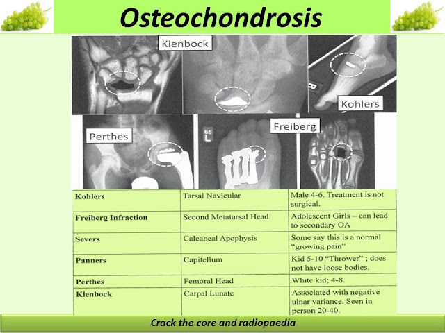 Easy Radiology: Osteochondrosis