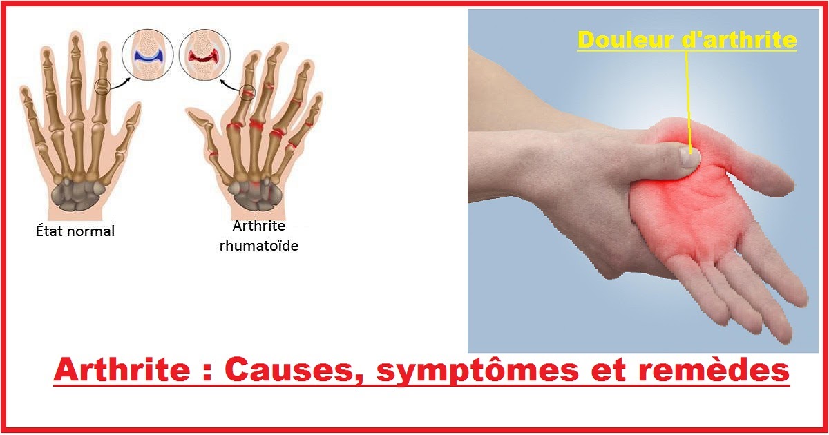 Arthrite : Causes, symptômes et remèdes ~ Sport et Santé