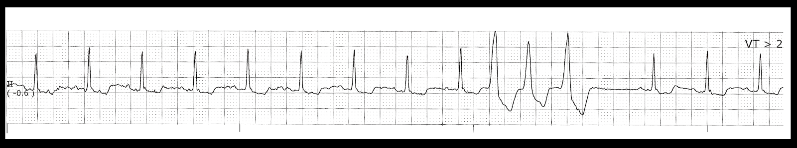 Practice Rhythm Strips 243