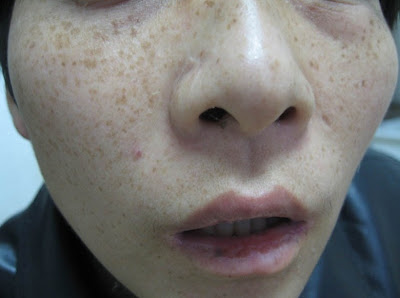 freckle on face: How does the freckles formed