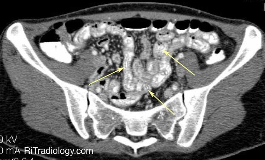 RiT radiology: Intestinal Ascariasis