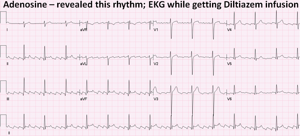 Pedi cardiology: Narrow Complex Tachycardia - Atrial Flutter
