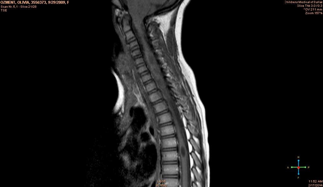 Children's Chiari Journal: CSF Flow Study part 1