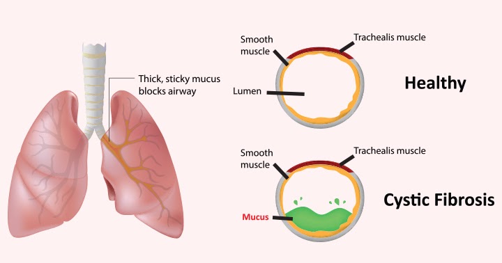 Our World: CYSTIC FIBROSIS