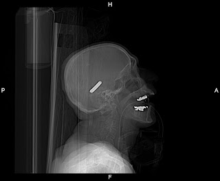 Post Gad: Nail Gun accident..