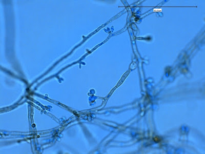 Fun With Microbiology (What's Buggin' You?): Fonsecaea pedrosoi/monophora