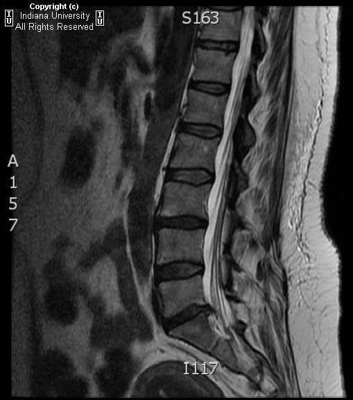 Neuroradiology On the Net: Lumbar disc extrusion with a wrapped disc