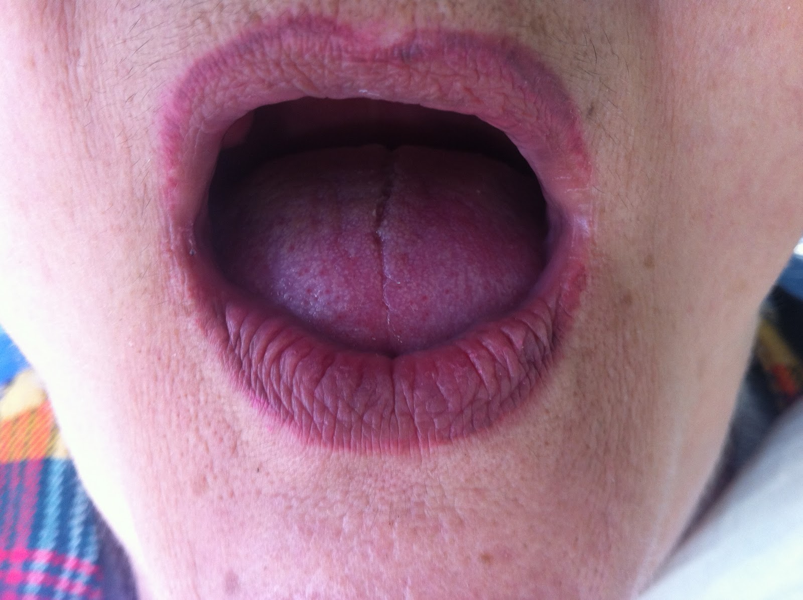 Clínica Ubiratã de Oliveira: Prótese Total sobre Implantes