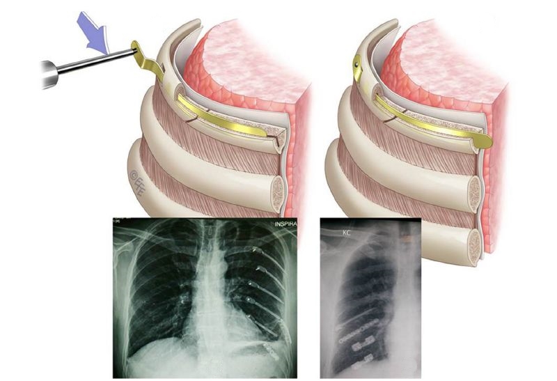 Revision Casos De Cirugia General: TORAX INESTABLE O TORAX FLOTANTE:
