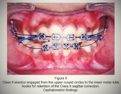 ORTHODONTICS: A new approach to retention of Class II Sagittal ...