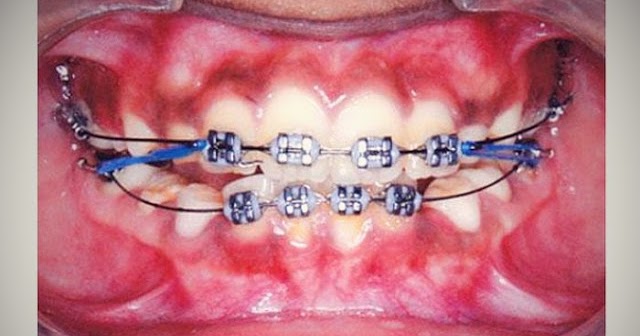 ORTHODONTICS: A new approach to retention of Class II Sagittal ...