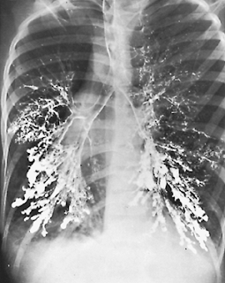 Chest Medicine Made Easy-Dr Deepu: The Rings !!!The Trams!!!, Chest X ...