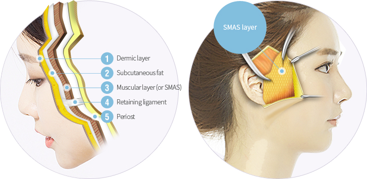 NaBella Clinic By NaBell: แนะนำ!!! ร้อยไหม SMAS LOCK คืออะไร ดีอย่างไร???