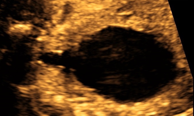 Journal Of Postgraduate Gynecology Obstetrics An Interesting Case Of Fetal Lower Urinary journal-of-postgraduate-gynecology-obstetrics-an-interesting-case-of-fetal-lower-urinary
