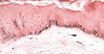 Chines Medicine Treatment for Vitiligo: About Acral lesions of vitiligo