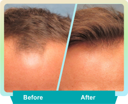 FUE Hair Transplant