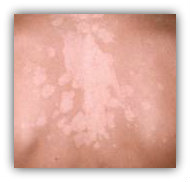 Panu Dan Cara Pengobatannya - Jerawat