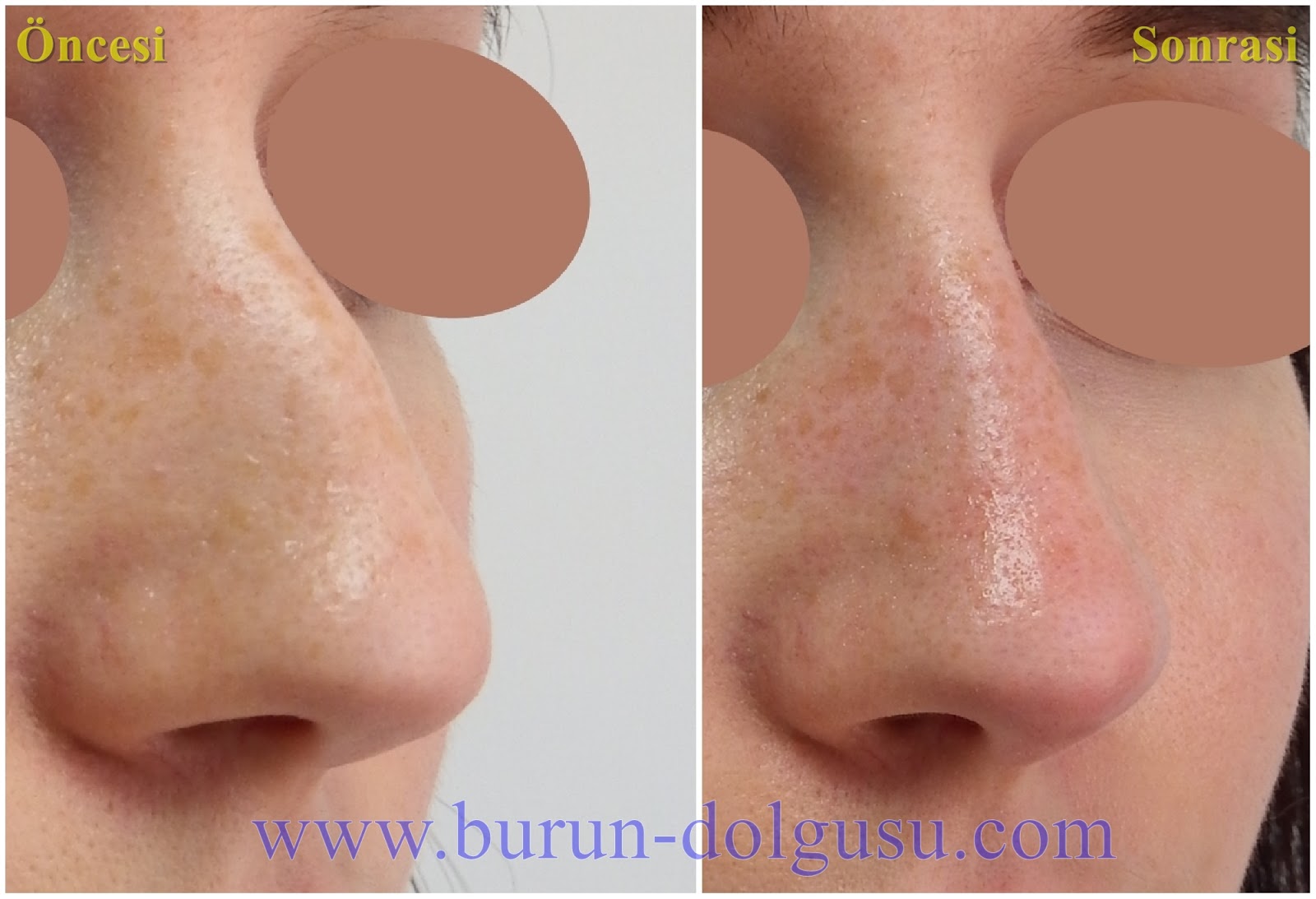 Estetiksiz Burun Küçültme Mümkün müdür?