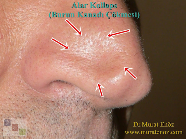 Nasal Valve Collapse and Treatment