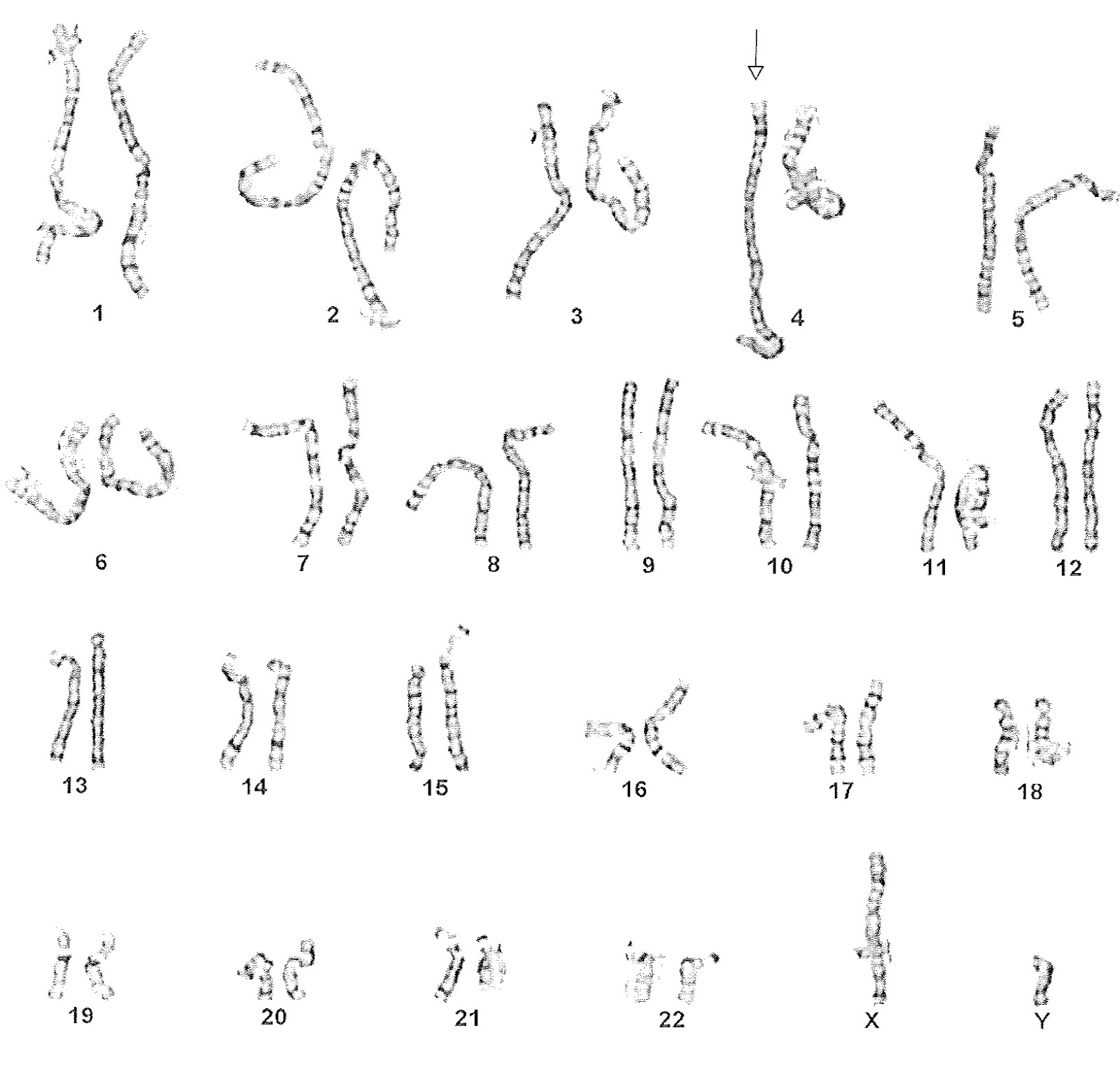 The Hoy House: 4Q Chromosome Duplication