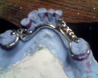 FER-DENTAL-LAB: PPR METALICAS