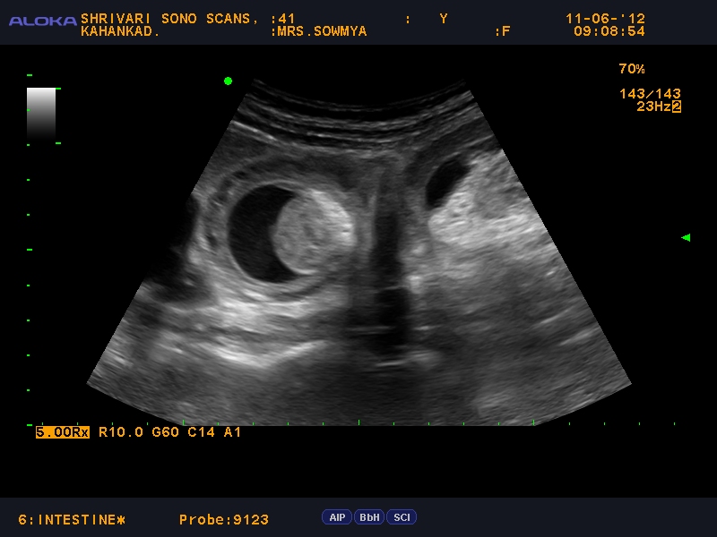 Shrivari Sono Scans: Small bowel intussusception secondary to ...