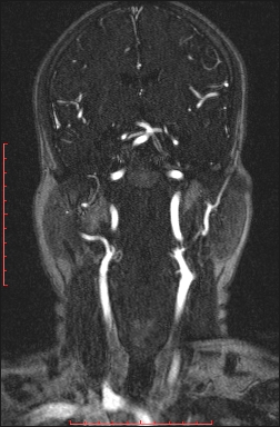 Ultimate Radiology : Another case of Fenestrated Left SCA - MRA