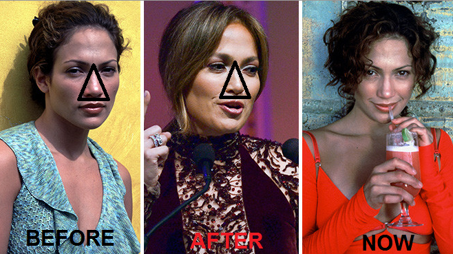 Jennifer Lopez Plastic Surgery Botox, Nose Job, Cheek Implants Before ...