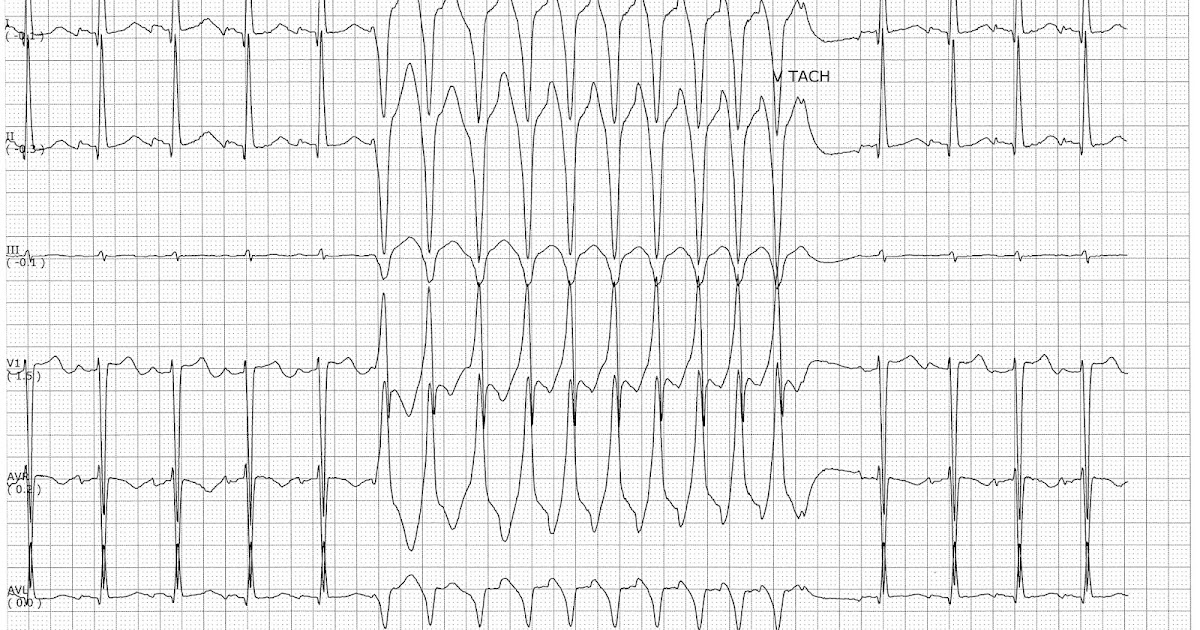 Sinus rhythm ivcd - garetblu