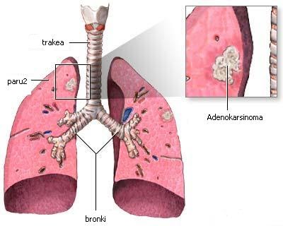 Bronchogenic Carcinoma | Procedure, Treatment and Therapy