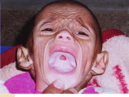 Wegener's granulomatosis | Diseases.x